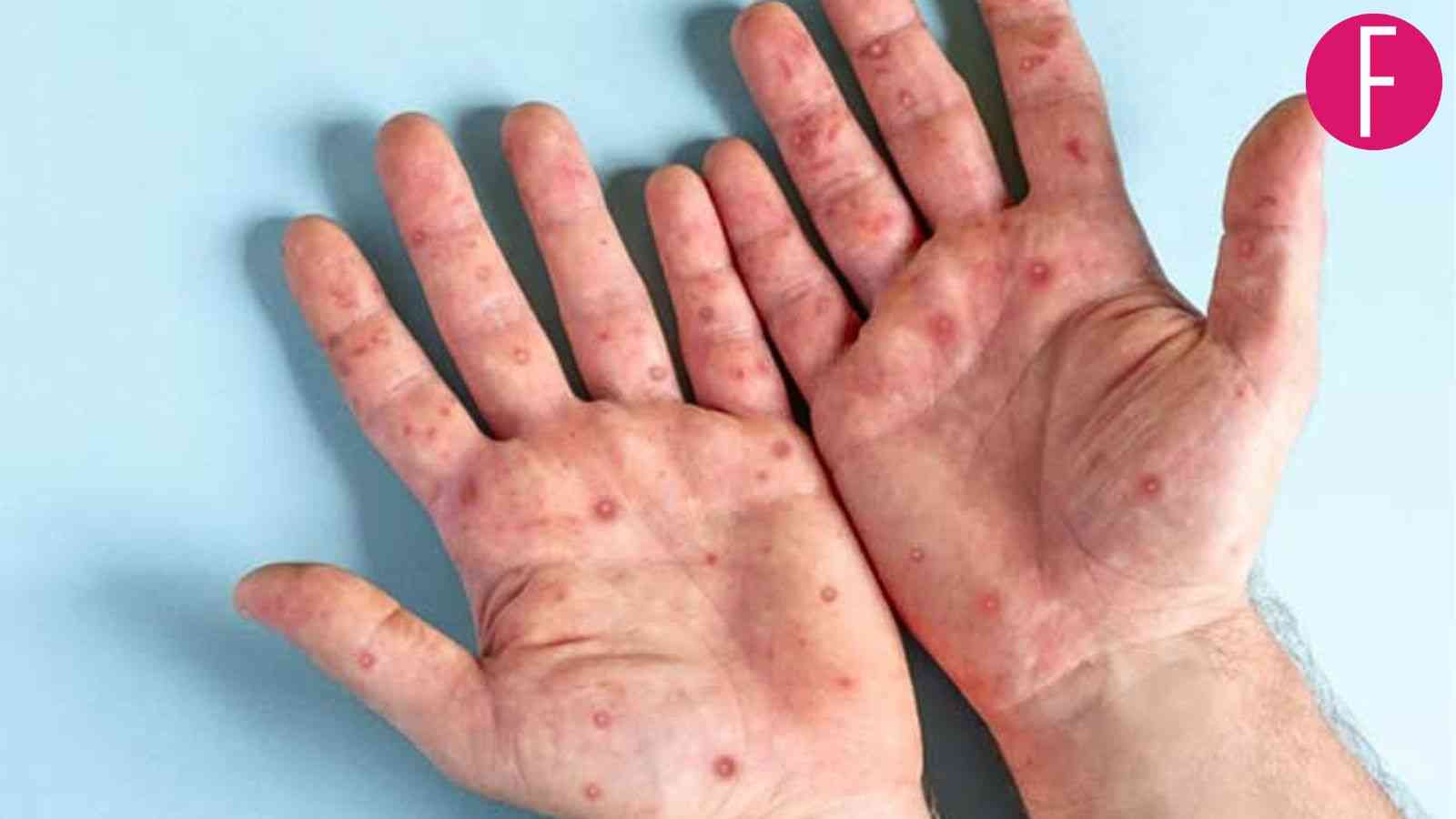 7 Vital Facts You Need To Know About Monkeypox